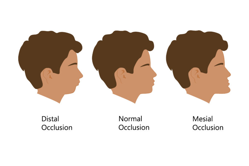 Jaw Repositioning | Ahava Orthodontics