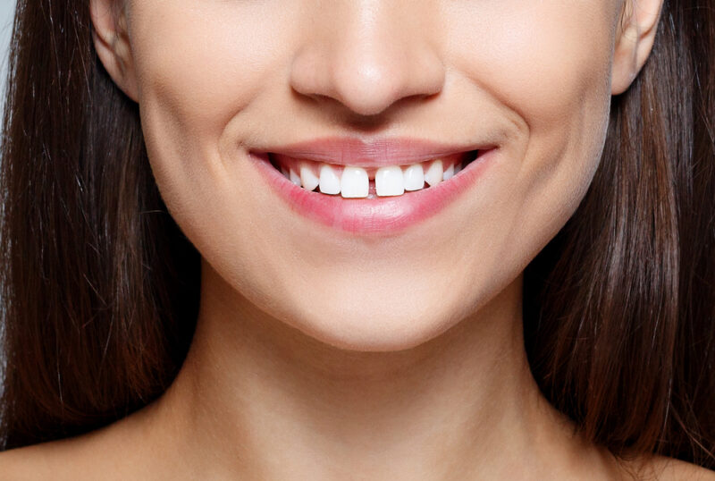 Can Braces Fix Gaps in Teeth? | Ahava Orthodontics