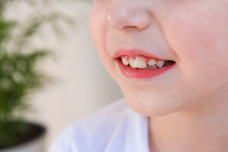Why Are My Child's Teeth Crowding? | Ahava Orthodontics