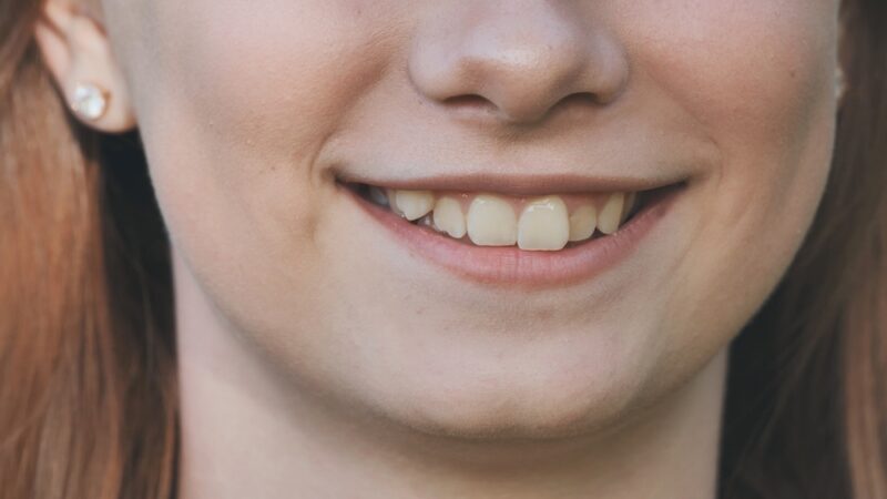 Signs and Symptoms Indicating the Need for Braces | Ahava Orthodontics