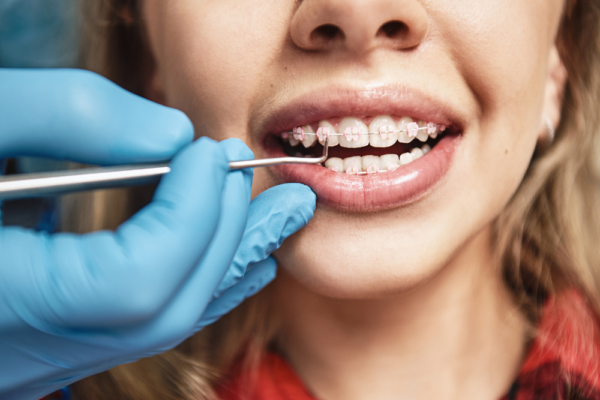 Comparing Braces Options in Fort Worth: Traditional, Ceramic, and ...