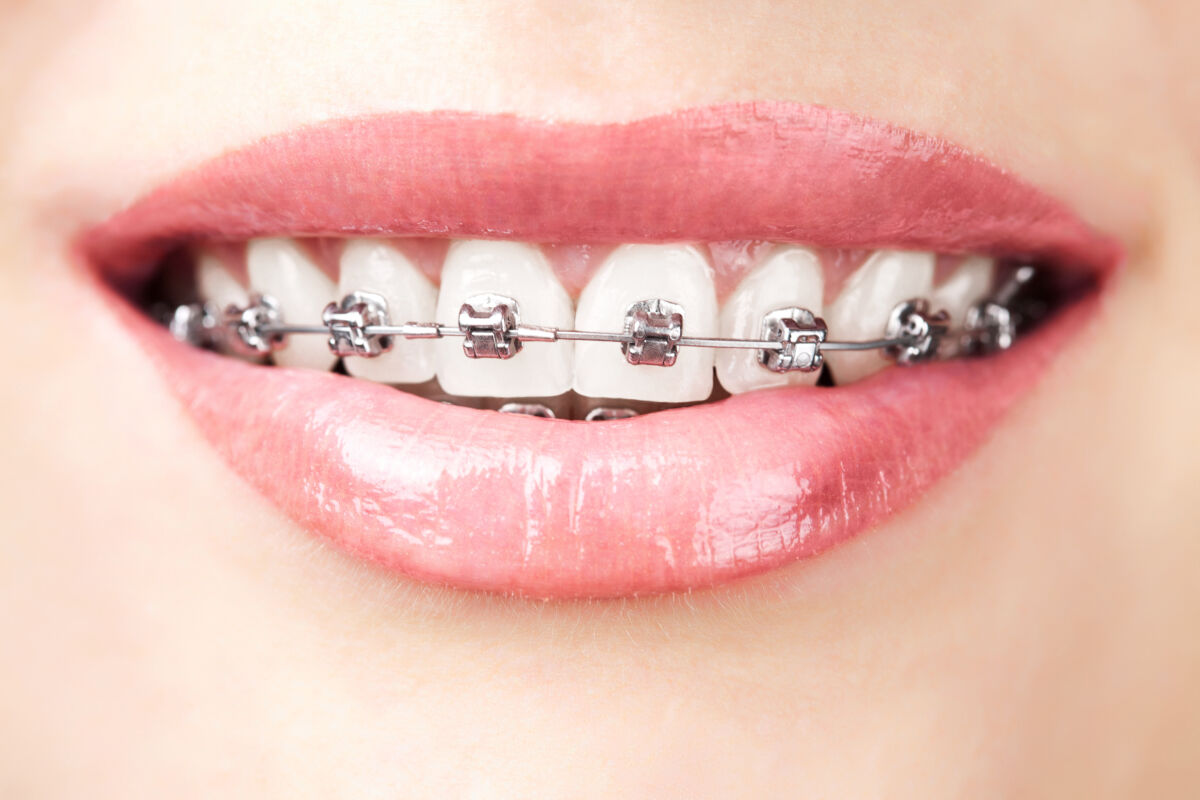 How to Avoid Broken Brackets | Ahava Orthodontics