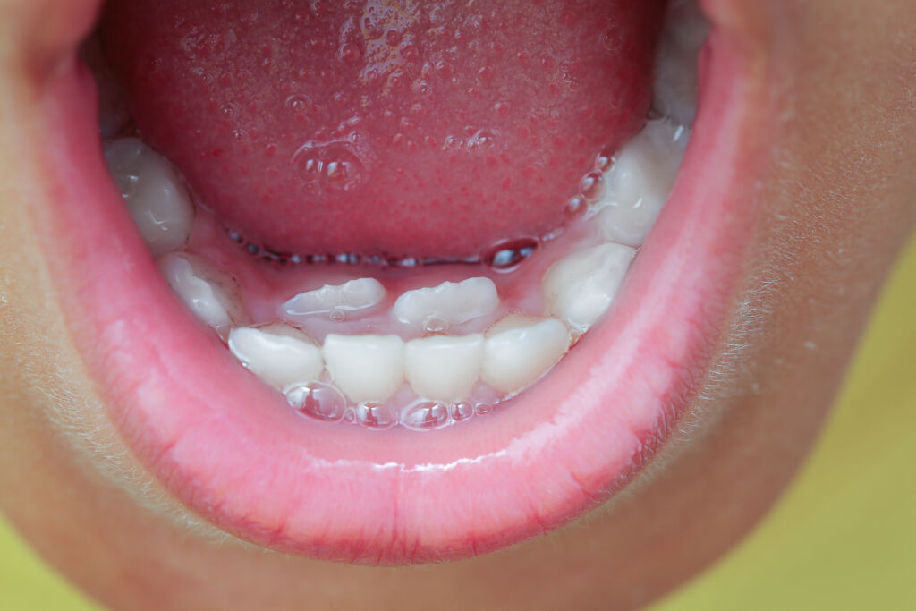 How We're Creating Space for Children's Adult Teeth | Ahava Orthodontics